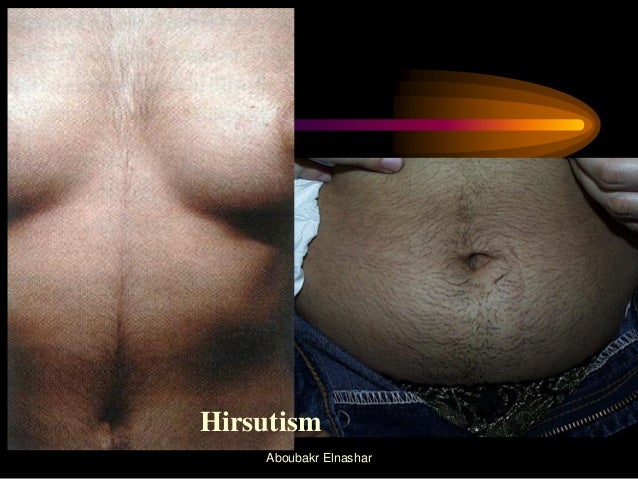 Hirsutism