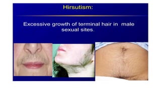 Hirsutism and virilism /. pdf | PDF