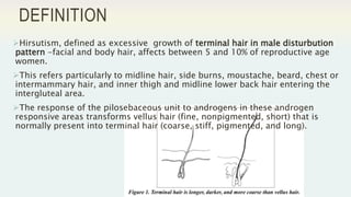 Hirsutism | PPTX
