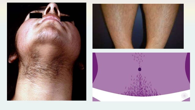 Hirsutism | PPTX | Hormonal Disorders | Endocrine and Metabolic Diseases