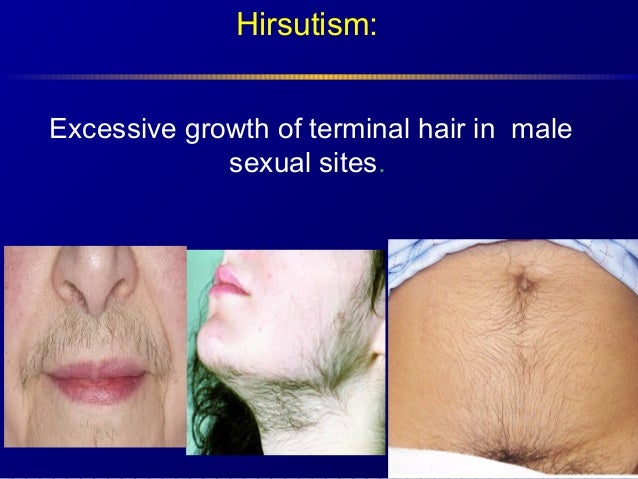 Hirsutism for undergraduate