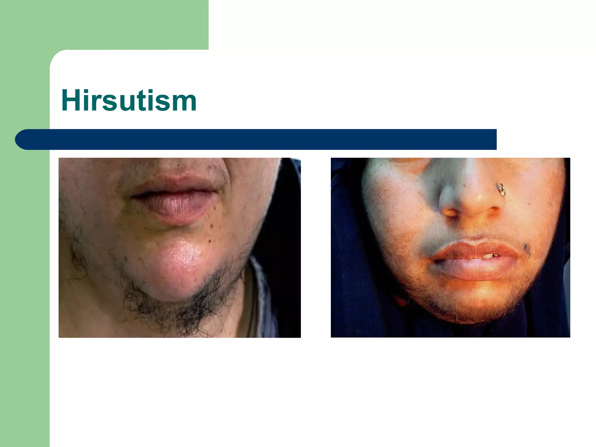 Hirsutism & Hypertrichosis | PPT