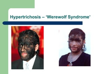 Hirsutism & Hypertrichosis | PPT