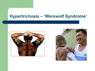 Hirsutism & Hypertrichosis | PPT
