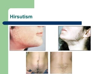 Hirsutism & Hypertrichosis | PPT