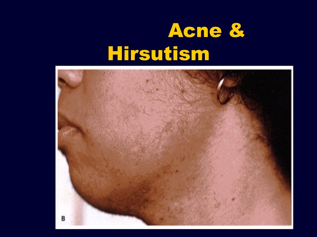 Hirsutism
