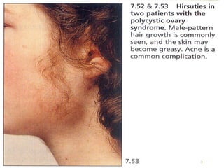 Hirsutism , Virilism, Gynaecomastia, Impotence | PPT