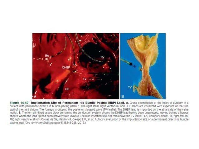 His bundle pacing | PPTX | Heart and Cardiovascular Diseases | Diseases ...
