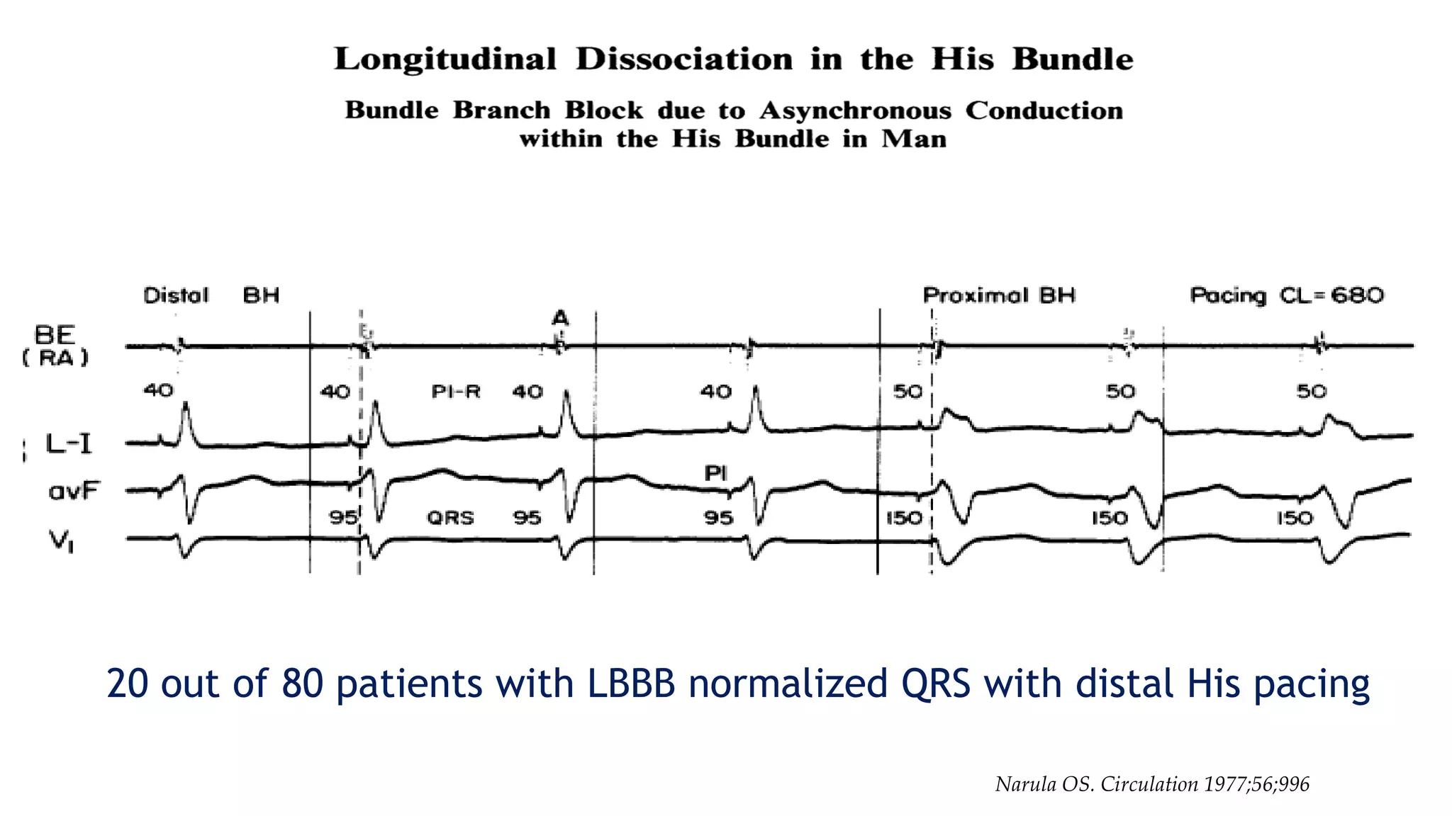 His bundle pacing as cardiac resynchronization therapy | PPTX