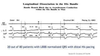 His bundle pacing as cardiac resynchronization therapy | PPTX