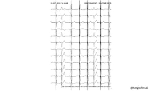 His bundle pacing as cardiac resynchronization therapy | PPTX