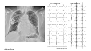 His bundle pacing as cardiac resynchronization therapy | PPTX