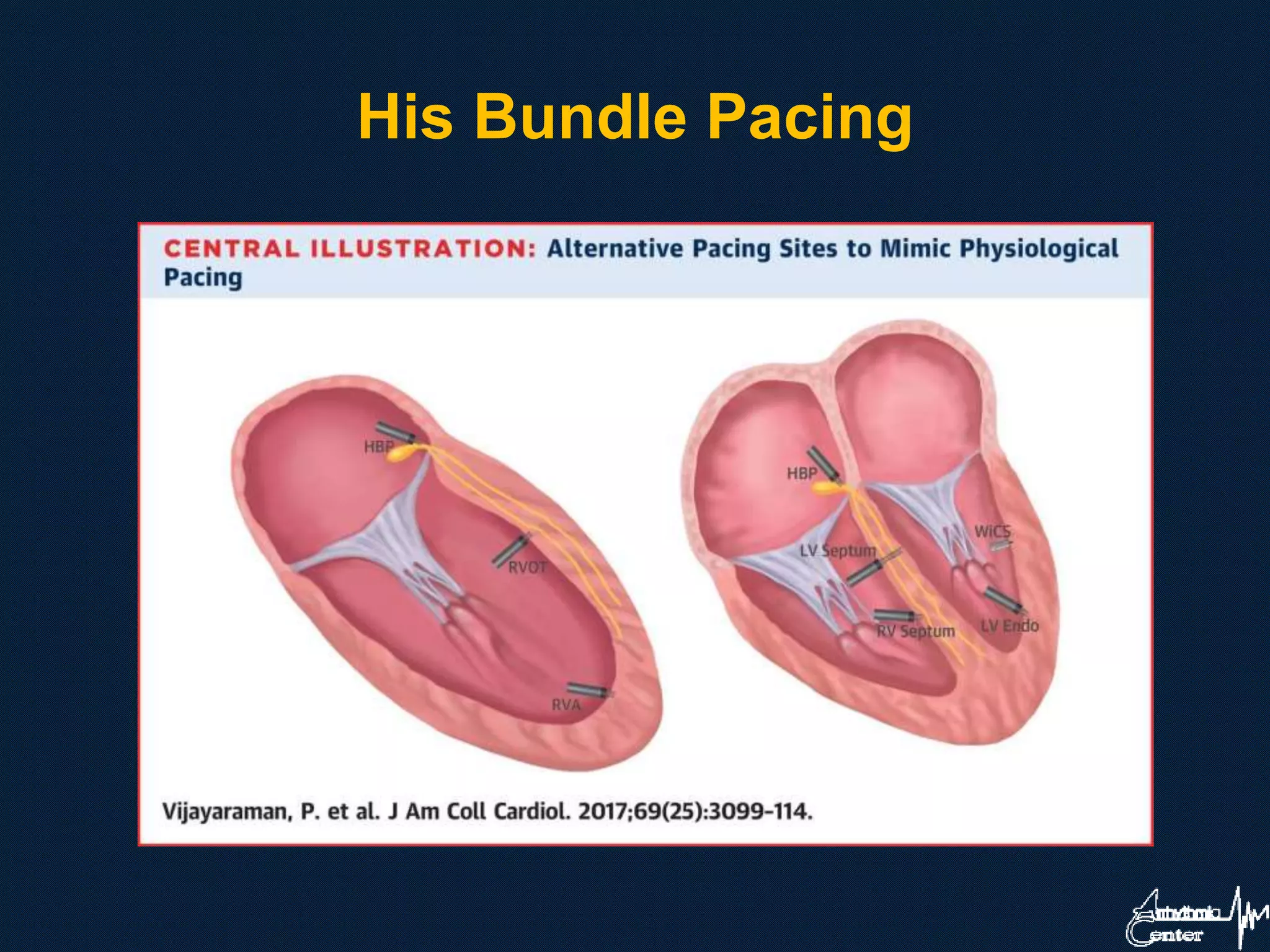 His resynchronization versus biventricular pacing | PPT