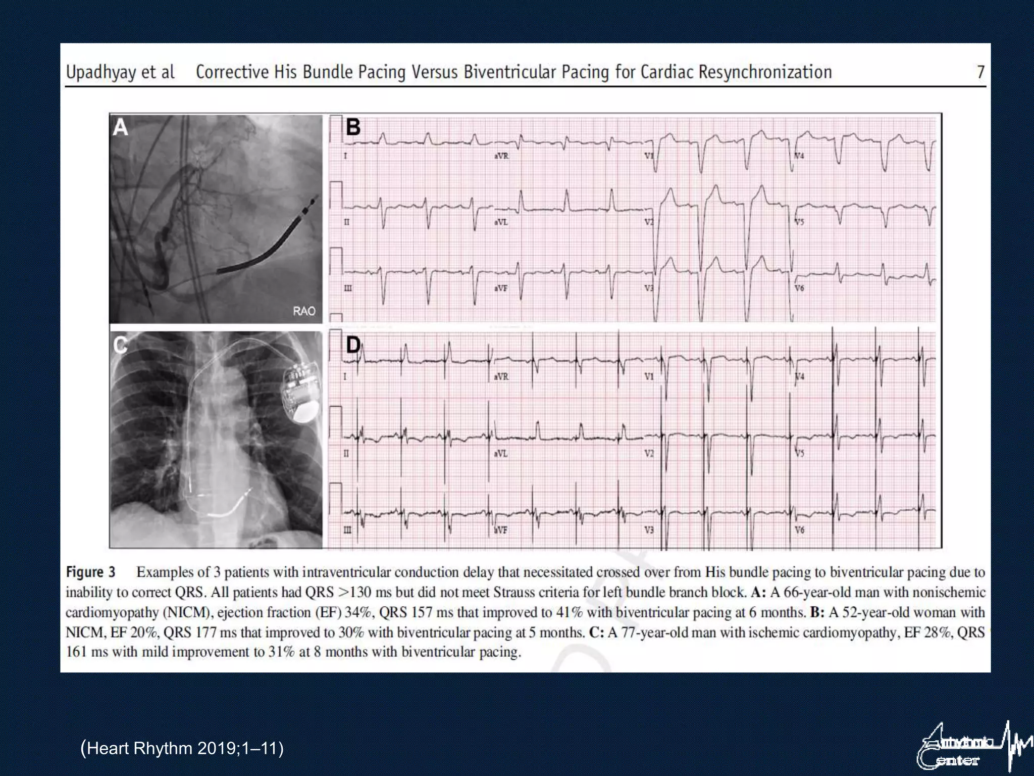 His resynchronization versus biventricular pacing | PPT