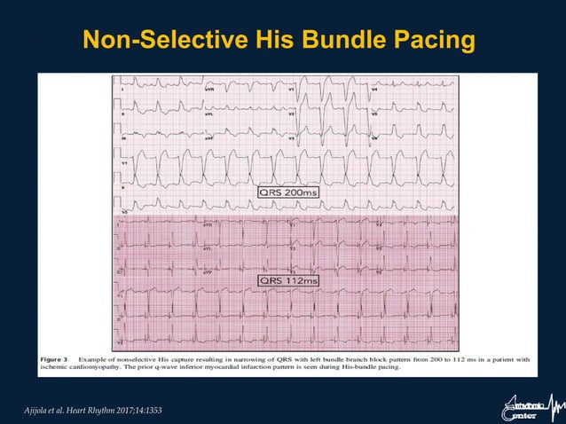 His resynchronization versus biventricular pacing | PPT