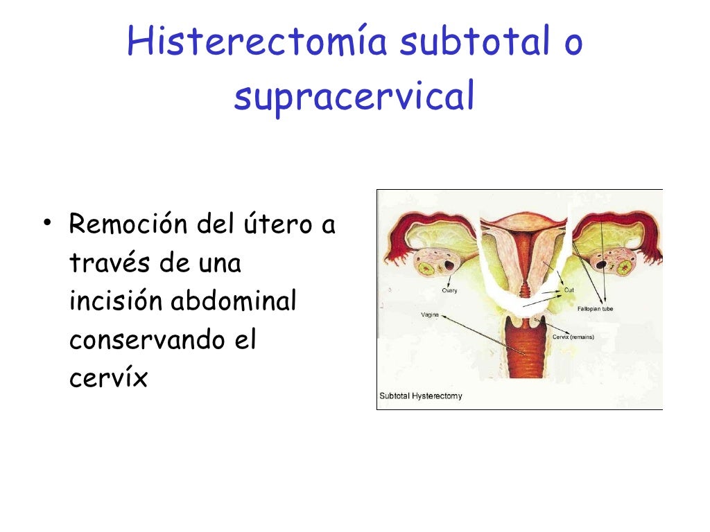 Complicaciones de la histerectomía – que significa histerectomia ...