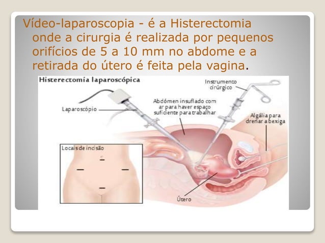 Histerectomia Cuidados De Enfermagem Ppt