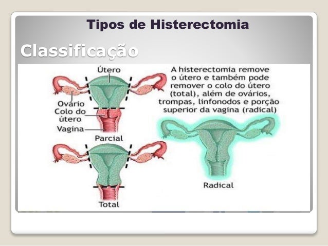 Histerectomia cuidados de enfermagem