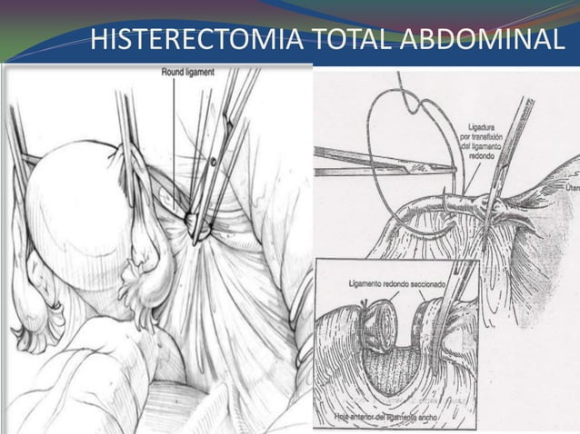 Histerectomia total abdominal tecnica quirúrgica