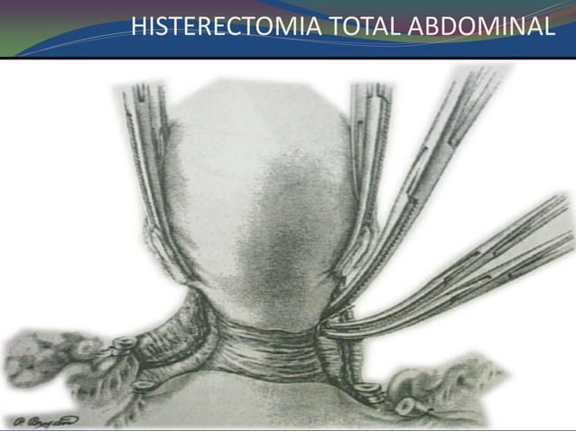 Histerectomia total abdominal tecnica quirúrgica