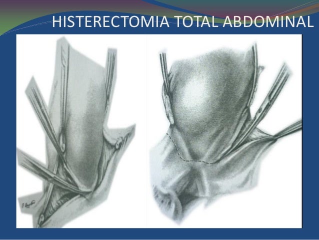 Histerectomia total abdominal tecnica quirúrgica