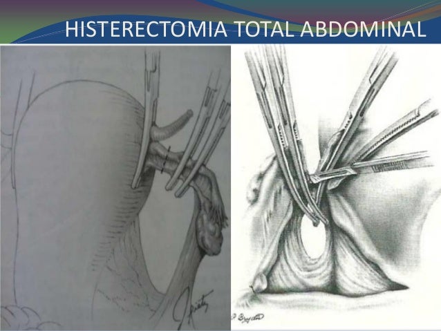 Histerectomia total abdominal tecnica quirúrgica
