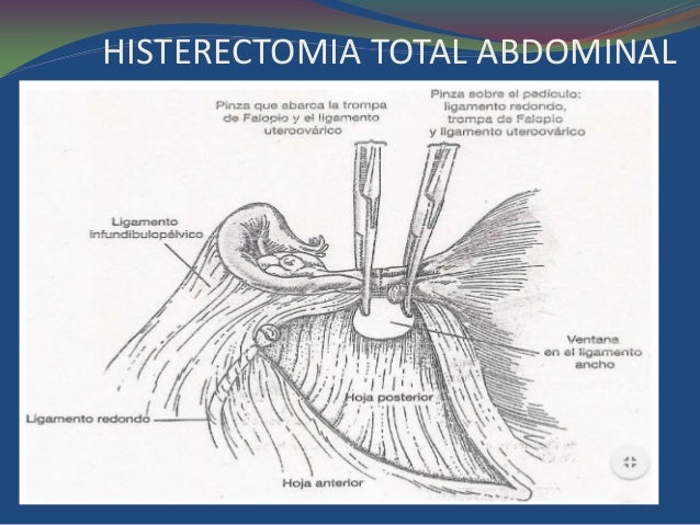 Histerectomia total abdominal tecnica quirúrgica
