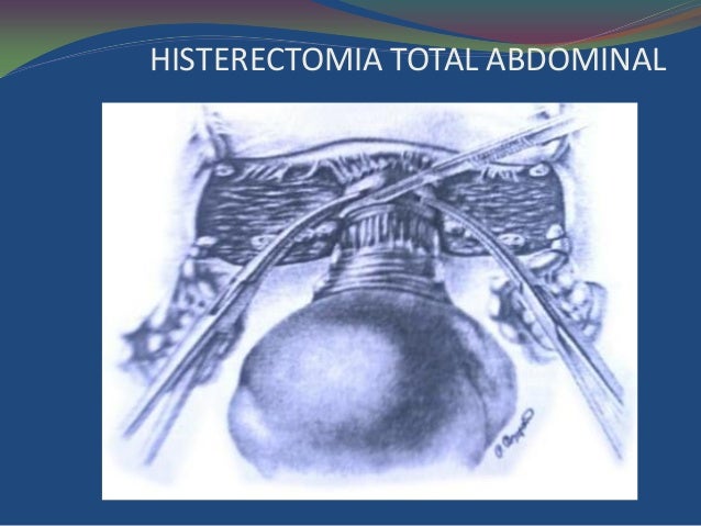 Histerectomia total abdominal tecnica quirúrgica