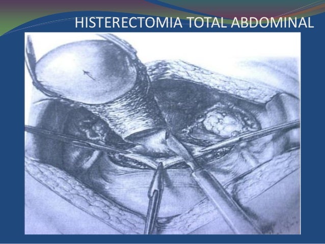 Histerectomia total abdominal tecnica quirúrgica