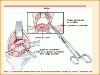Histerectomia Vaginal Tecnica Quirurgica Pptx