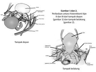 Jenis dan Perbedaan Histerektomi pada Kasus Ginekologi | PPTX