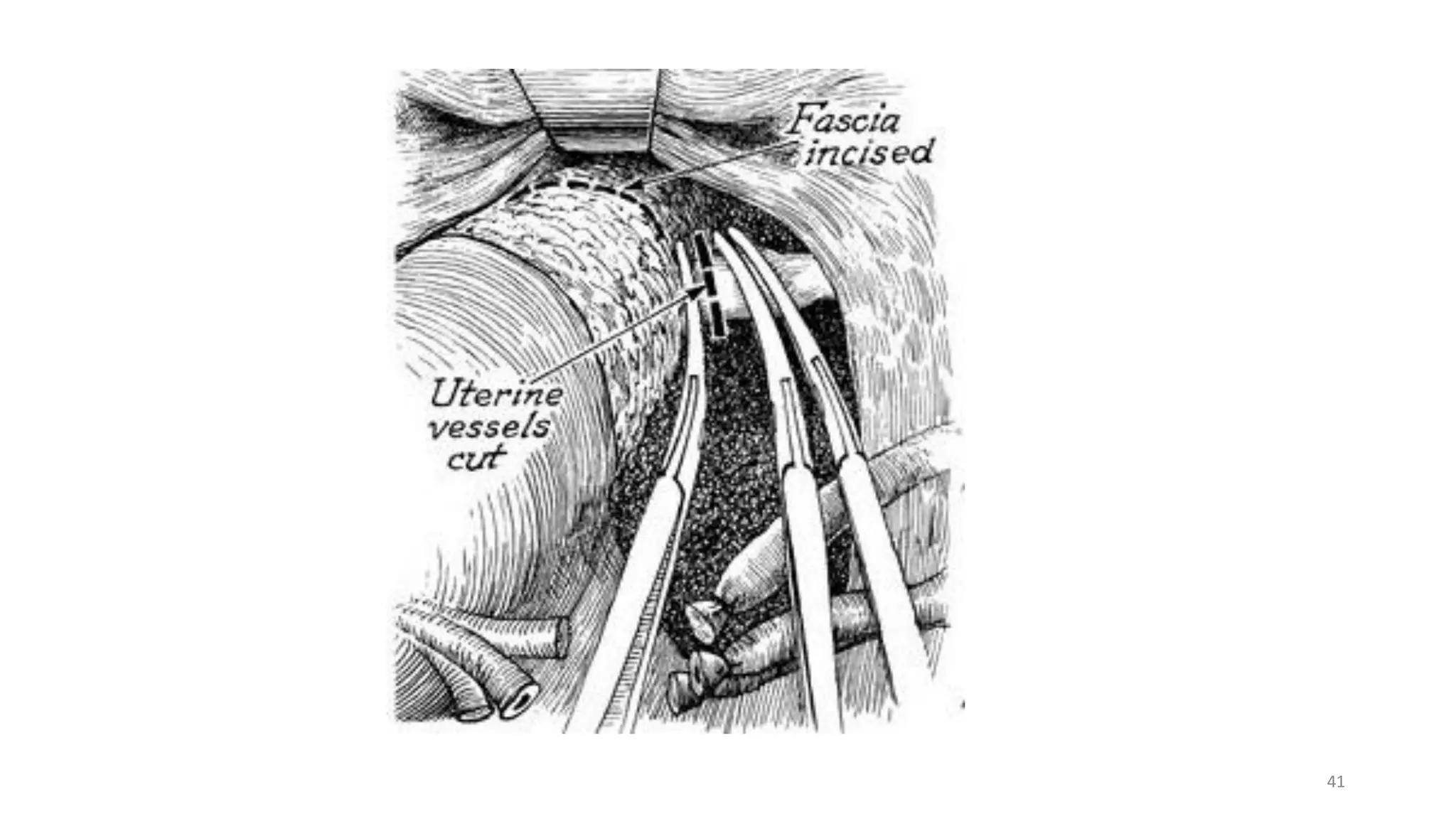Histerektomi postpartum | PPT