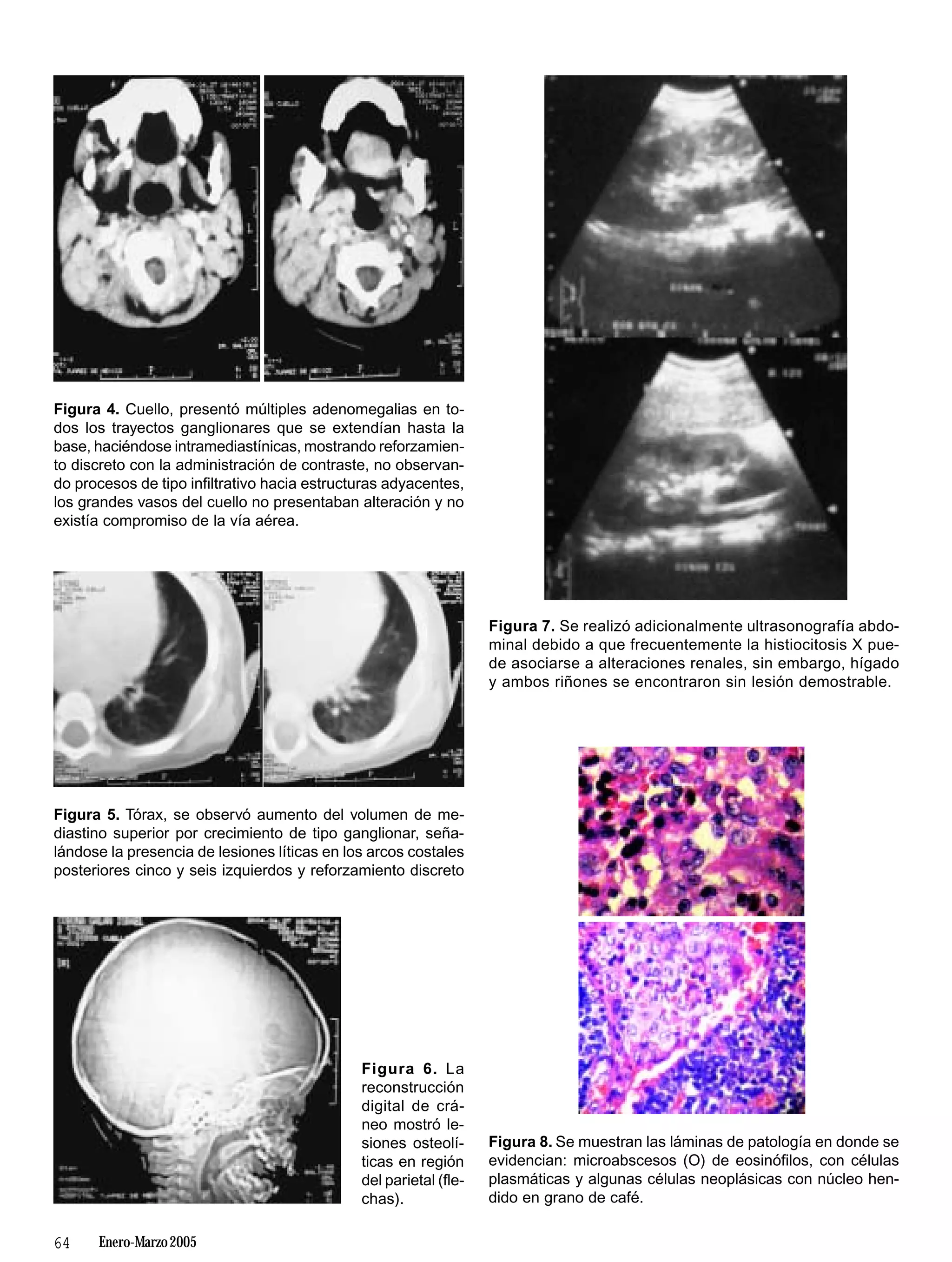 Histiocitosis X. Presentación de un caso con extensión multisistémica | PDF