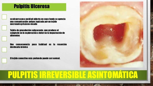 Histologia de la pulpitis