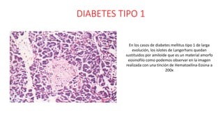 Diabetes Tipo 1 Páncreas Histología