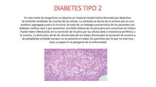 Diabetes Tipo 1 Páncreas Histología