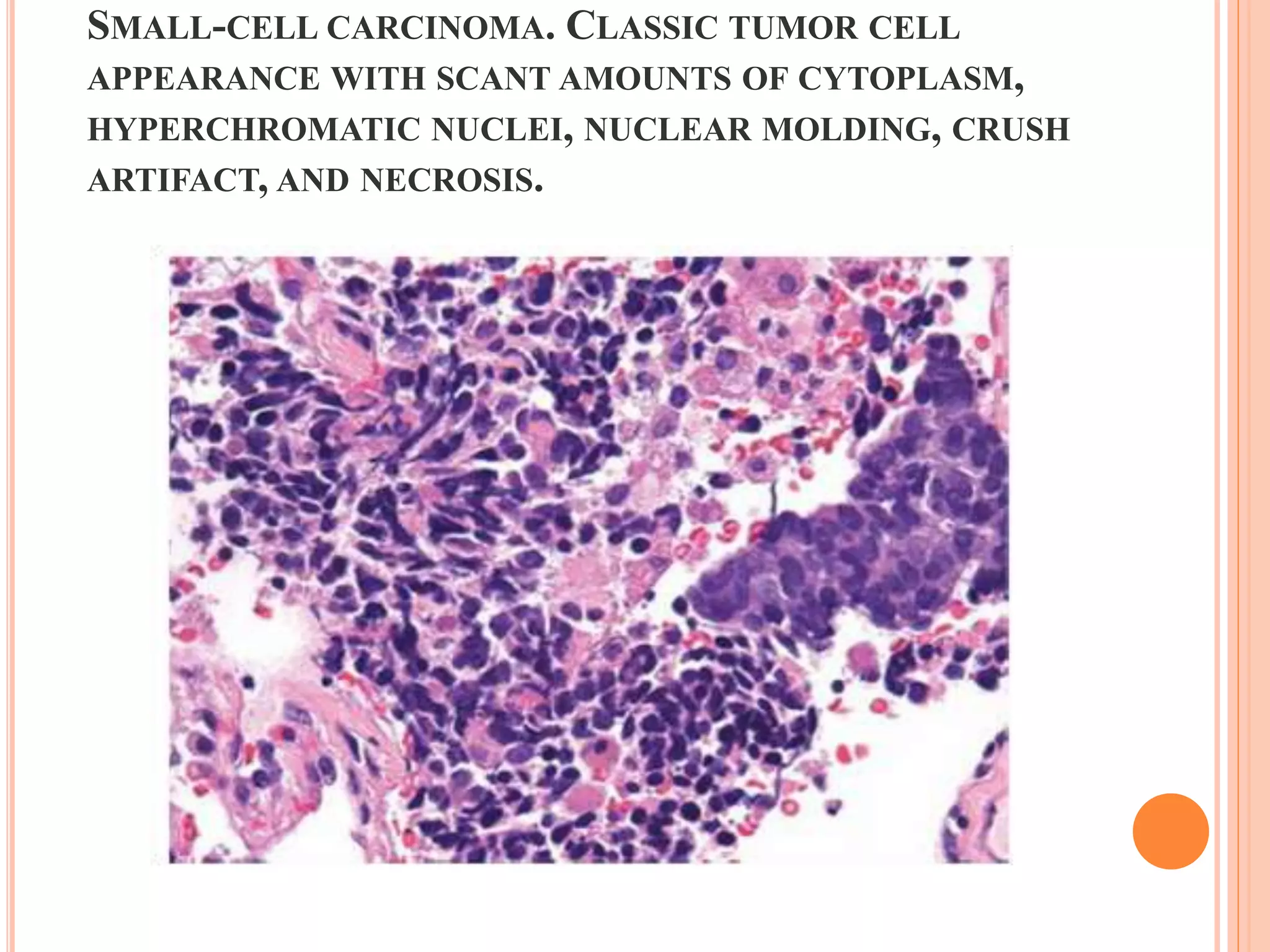 Histology and staging of lung cancer & metastatic | PPTX