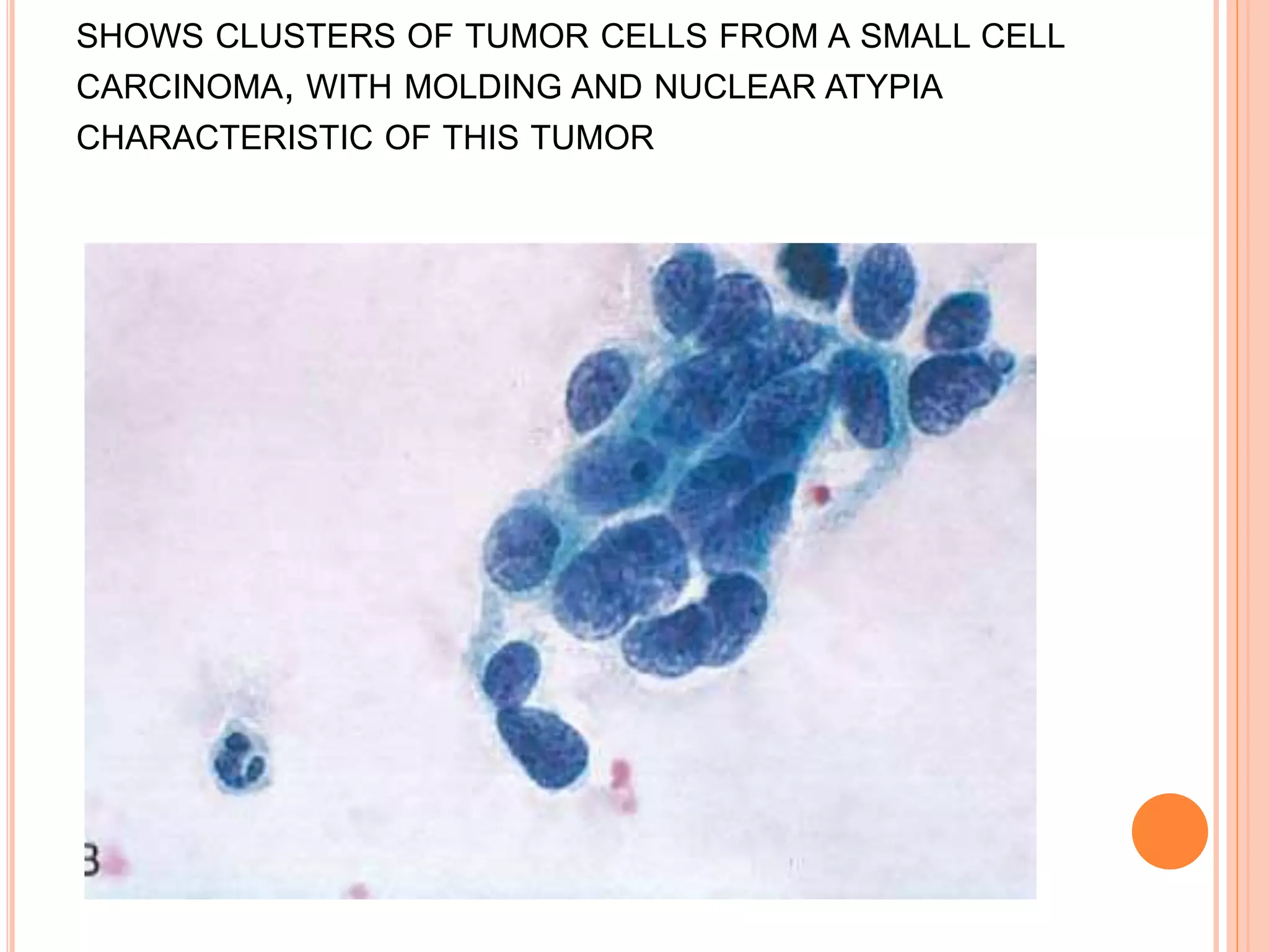 Histology and staging of lung cancer & metastatic | PPTX