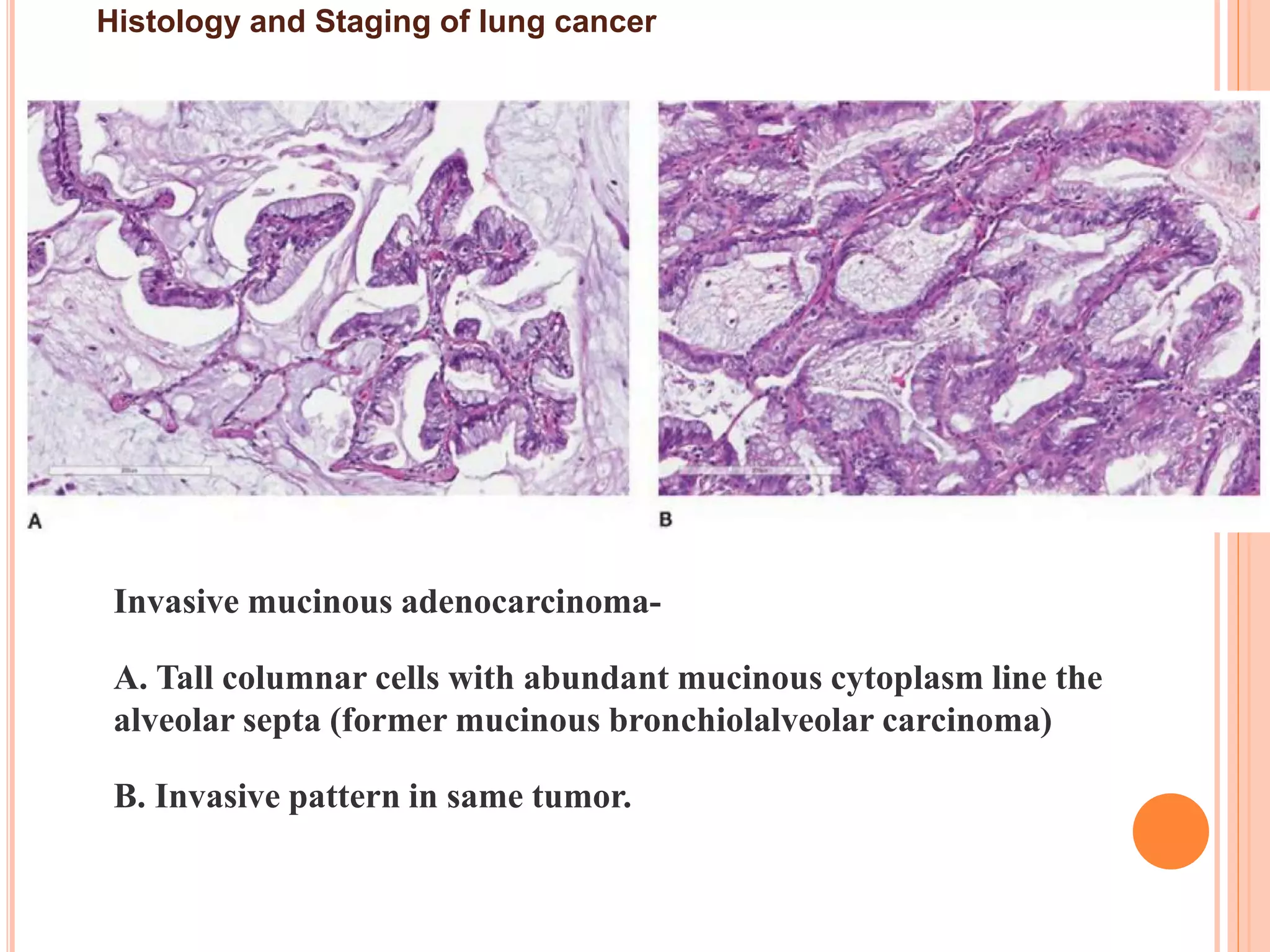 Histology and staging of lung cancer & metastatic | PPTX