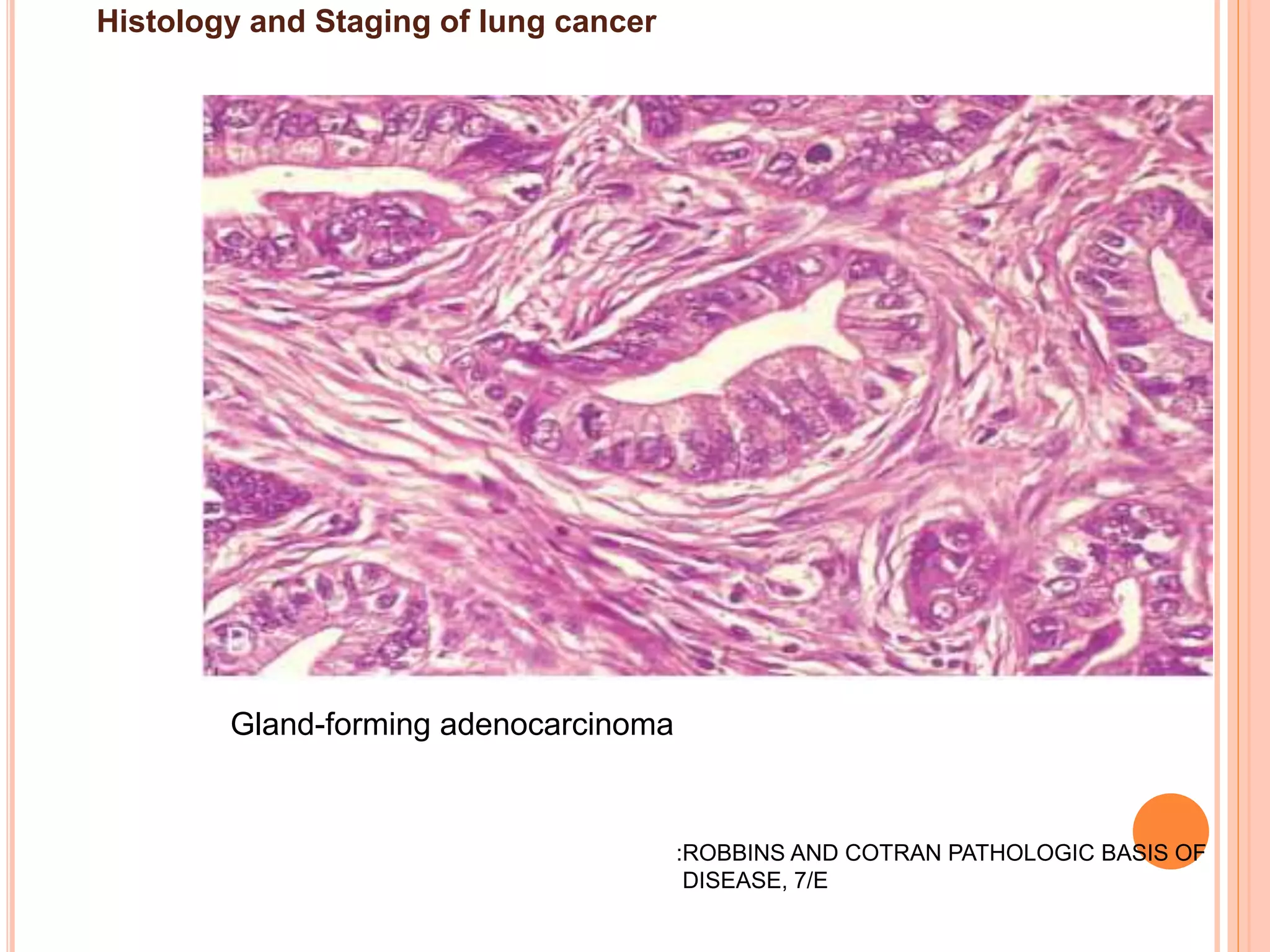 Histology and staging of lung cancer & metastatic | PPTX