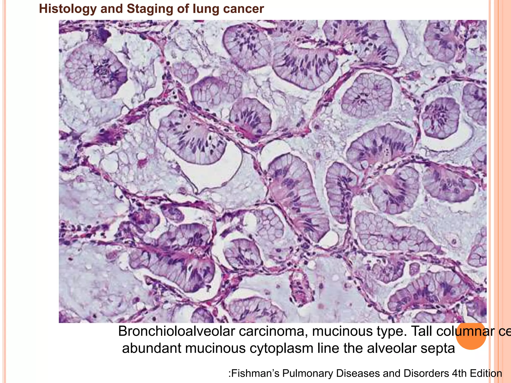 Histology and staging of lung cancer & metastatic | PPTX