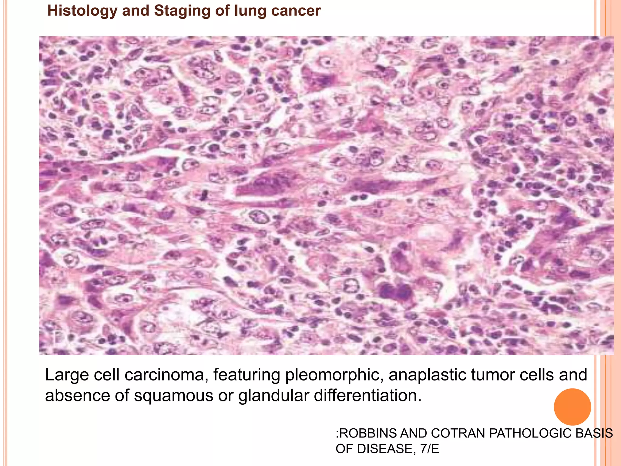 Histology and staging of lung cancer & metastatic | PPTX