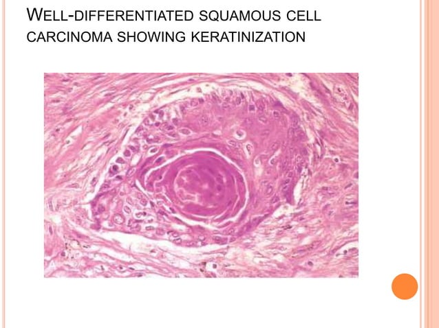 Histology and staging of lung cancer & metastatic | PPT