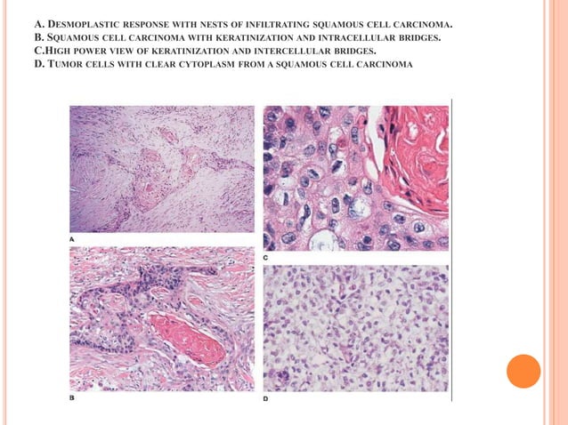 Histology and staging of lung cancer & metastatic | PPT