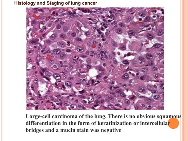 Histology and staging of lung cancer & metastatic | PPT
