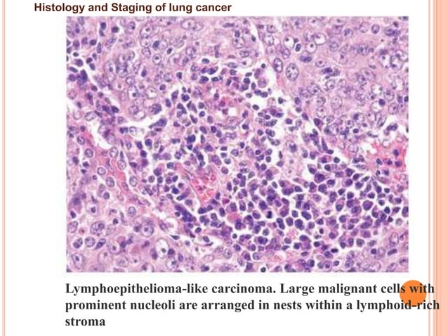 Histology and staging of lung cancer & metastatic | PPT