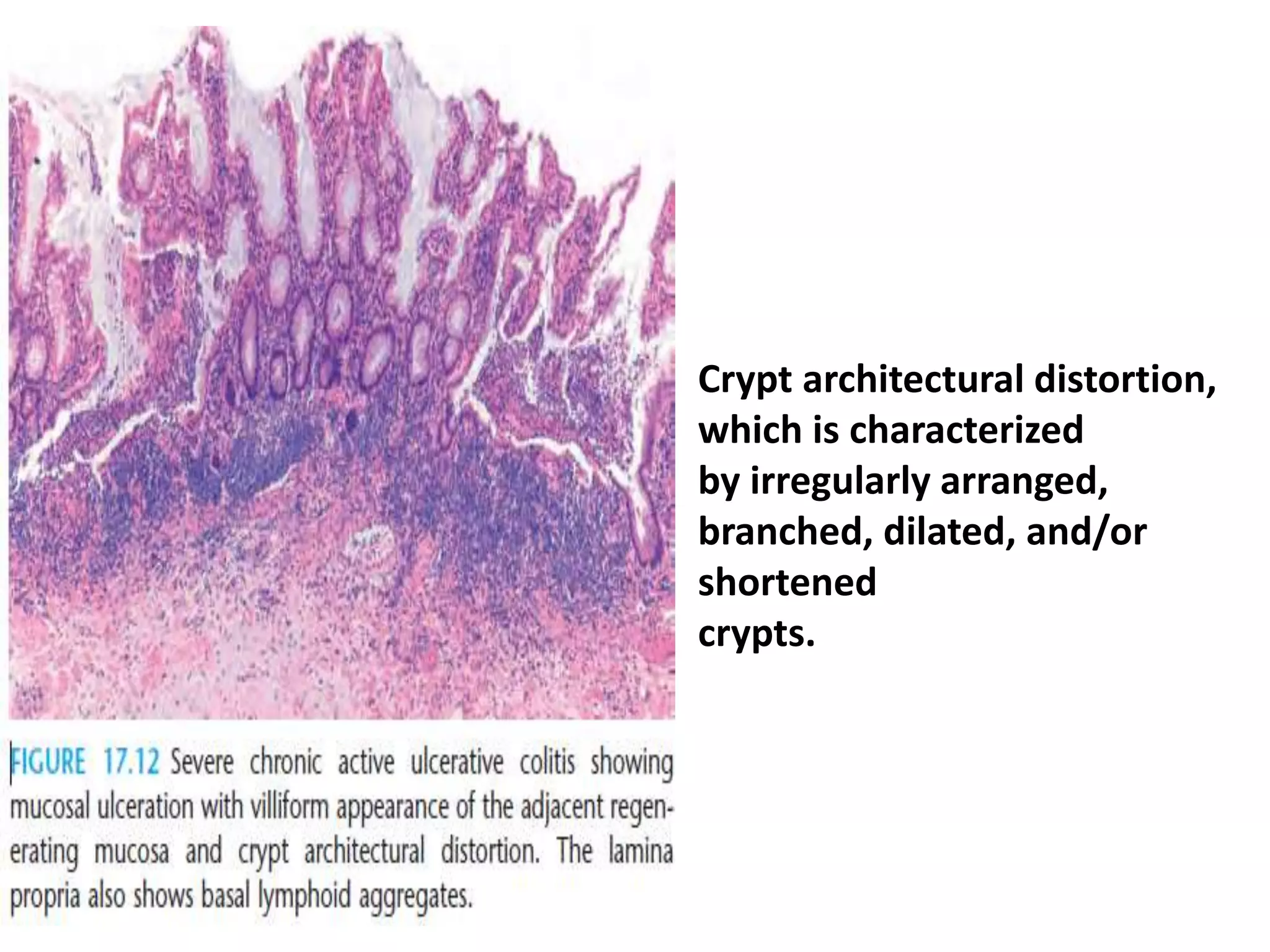 Histology of ibd | PPTX