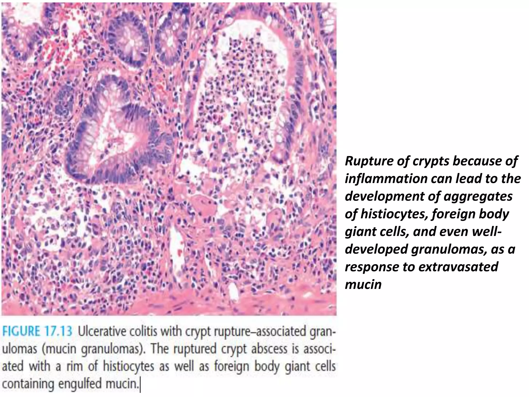 Histology of ibd | PPTX