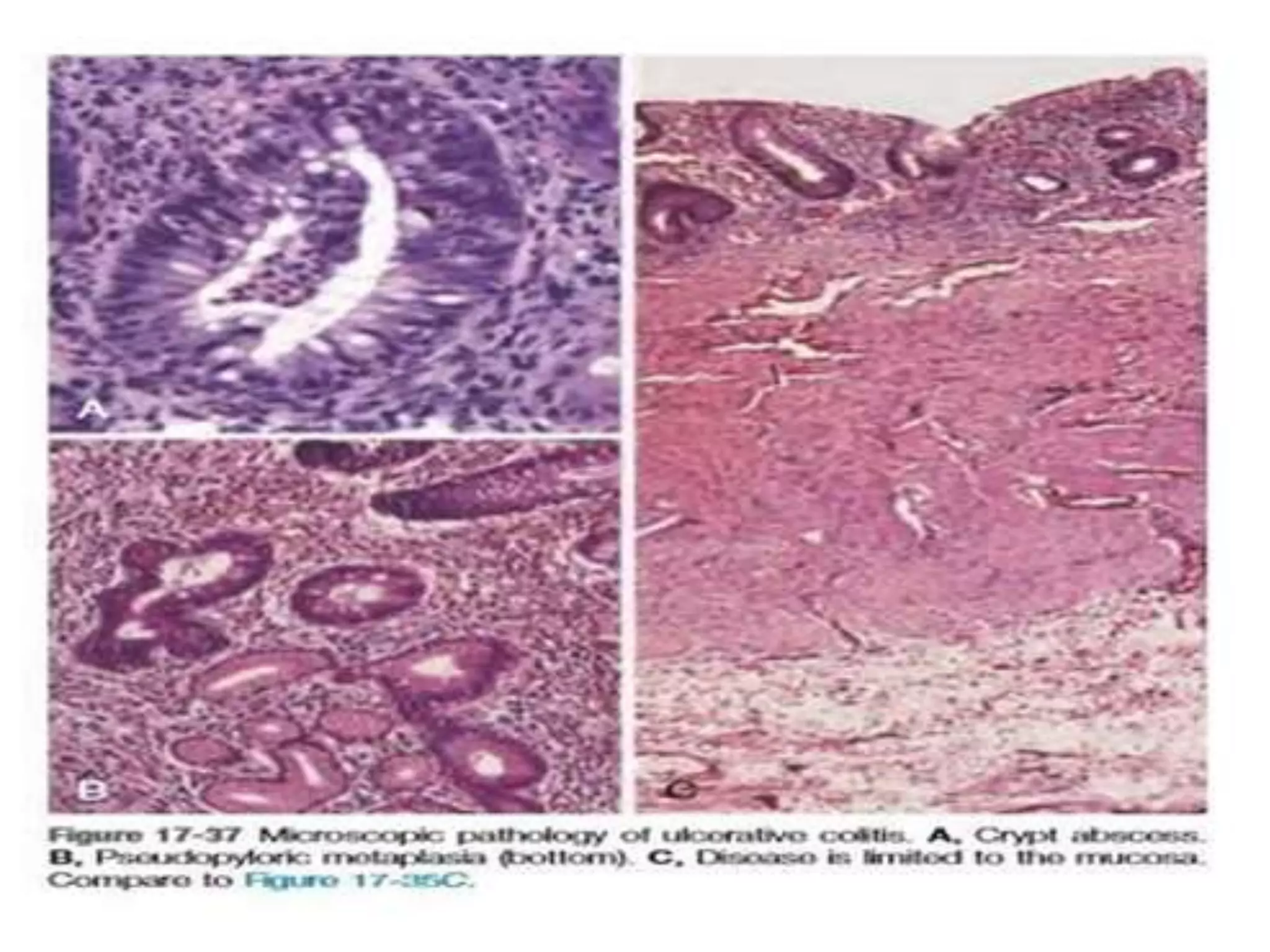 Histology of ibd | PPTX