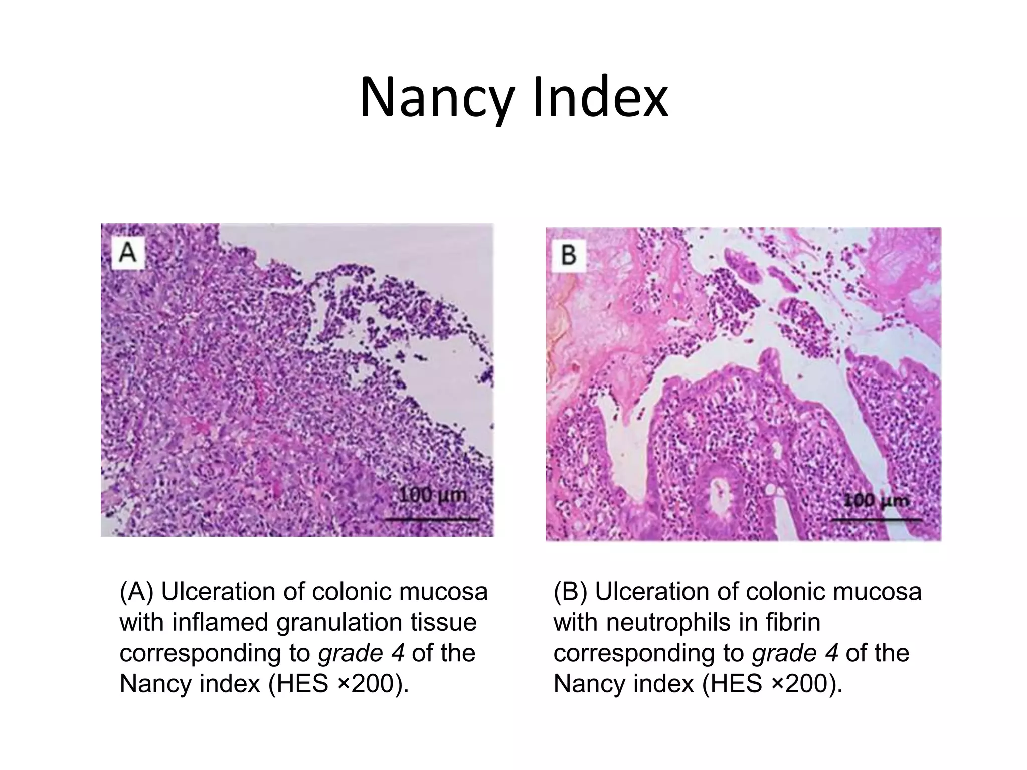 Histology of ibd | PPTX